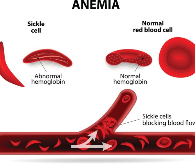What is Anemia - Woodlands Functional Family Medicine